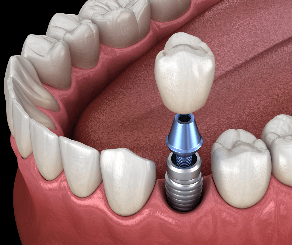 Are Implant Retained Dentures Right for You | Denture implant